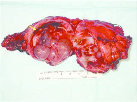 D Gross Surgical Specimen In A Patient With Mcn Multiple Cystic Download Scientific Diagram