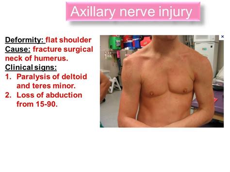 Axillary Web Syndrome