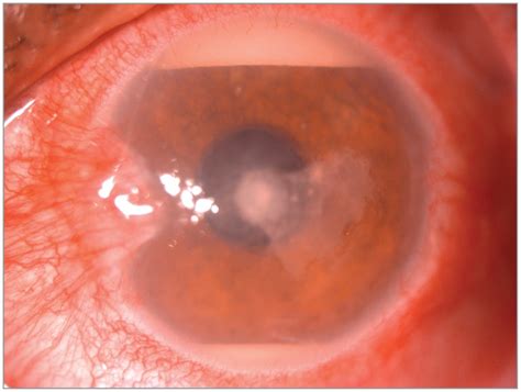 Jama Ophthalmology On Linkedin Mirror Hypopyon—corneal Ulcer With Hypopyon In A Silicone Oil