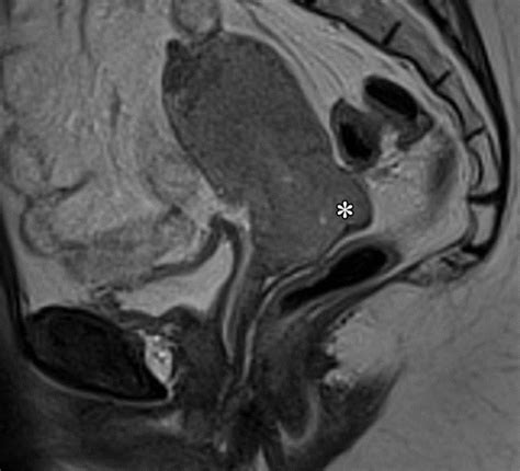 2018 Figo Staging Classification For Cervical Cancer Added Benefits Of