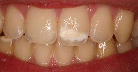 What Causes Chalky Teeth Aka Hypomineralisation Plainland Dental