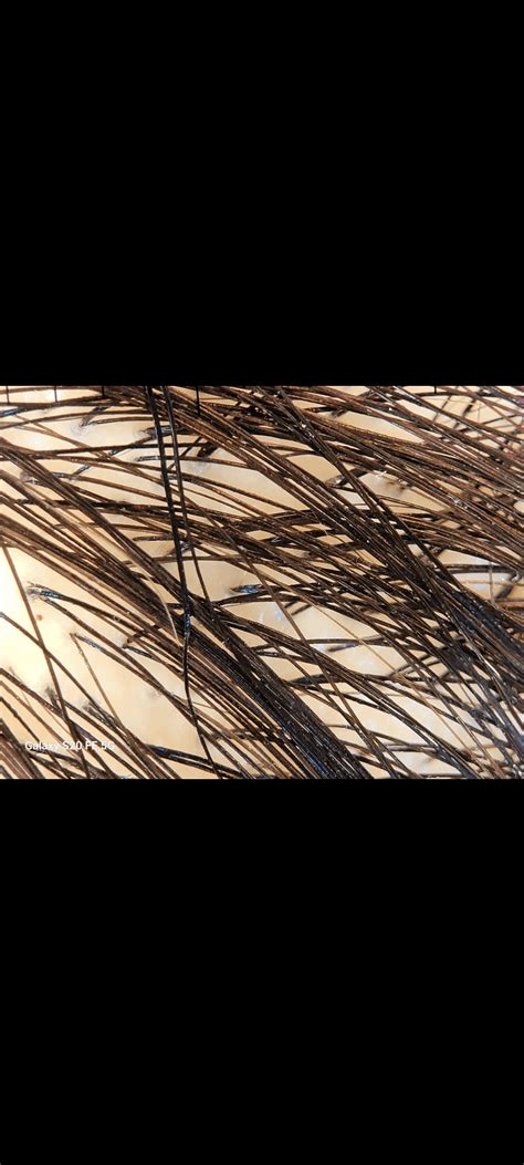 Got A Trichoscopy Done R Hairloss