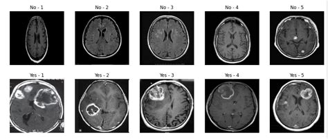 Brain Tumor Detection Using Vgg16 An Approach With Mri Image Analysis