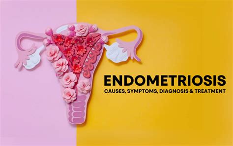 Endometriosis Whats Really Going On