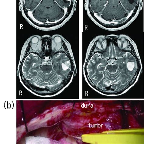 5diffuse Astrocytoma Grade 2 Occipito Temporo Parietal A Axial