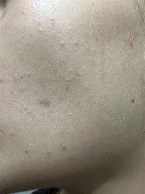 Tiny Pimples All Over My Cheeks Please Help Rskincareaddicts