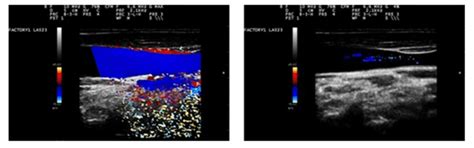 Examples Of Incorrect Doppler Insonation Angles Of 90° Degrees Above Download Scientific