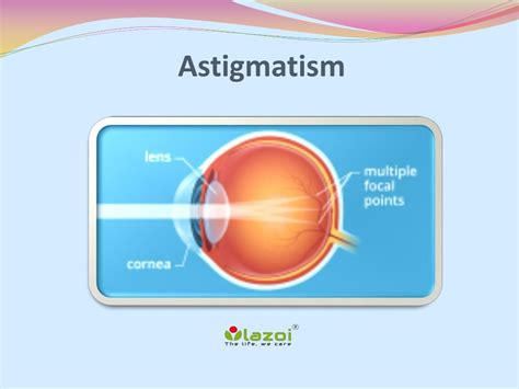 Ppt Astigmatism Powerpoint Presentation Free Download Id 7925991