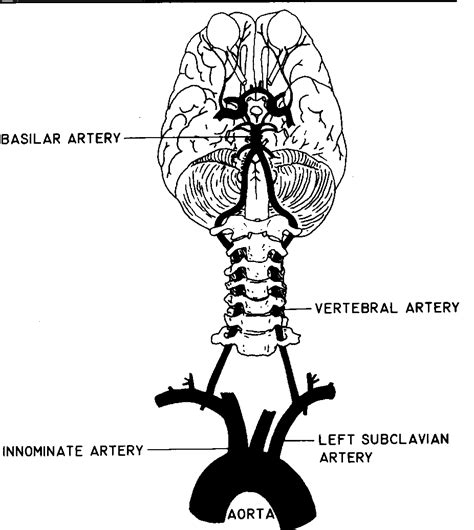 Figure 1 From Vertebral Basilar Insufficiency Semantic Scholar