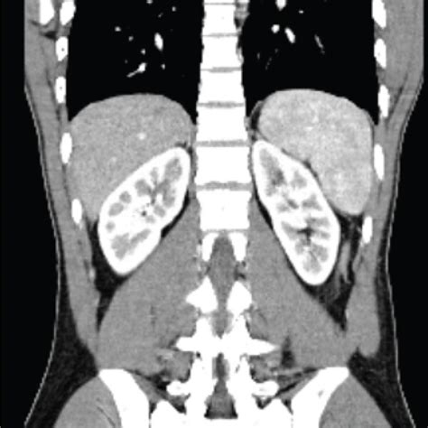 Posteroanterior View Of Left Nephrogram Showing An 8 Cm Mid Ureter