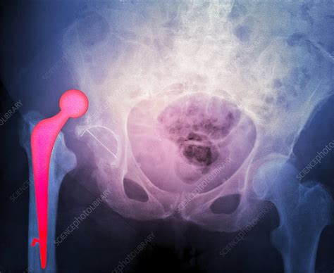 Dislocated Hip Prosthesis X Ray Stock Image C0032977 Science