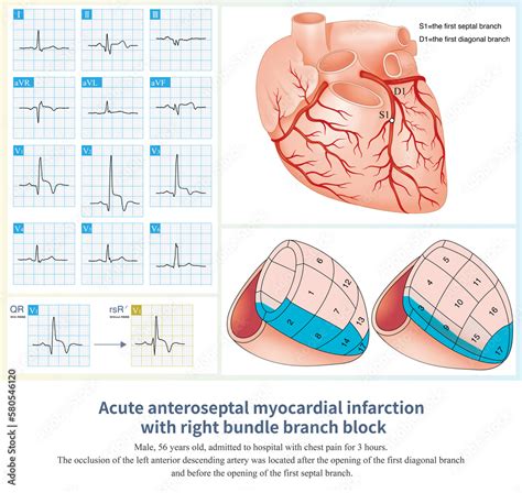 Counterclockwise Rotation Is A Common Ecg Phenomenon Which Is Partly A