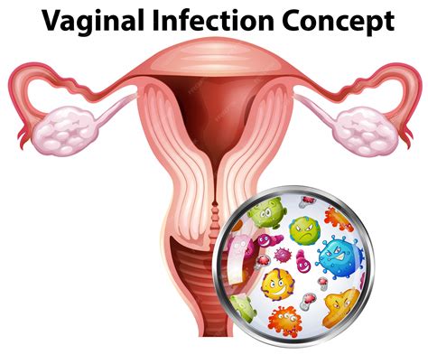 Vaginal Bacterial Infection