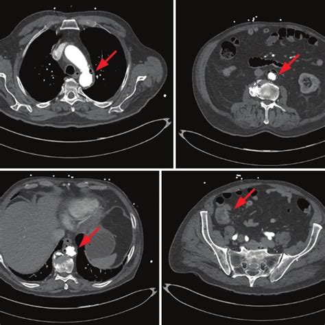 Initial Computed Tomographic Aortogram Findings Air In The Thoracic Download Scientific