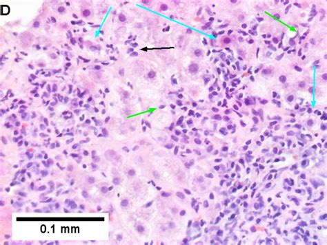 Primary Biliary Cirrhosis Libre Pathology