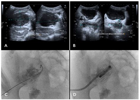 Image Guided Percutaneous Drainage Of Abdominal Abscesses In Pediatric Patients Pmc