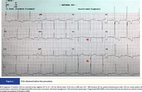 Figure 1 From Left Septal Fascicular Block Following Alcohol Septal Ablation For Hypertrophic
