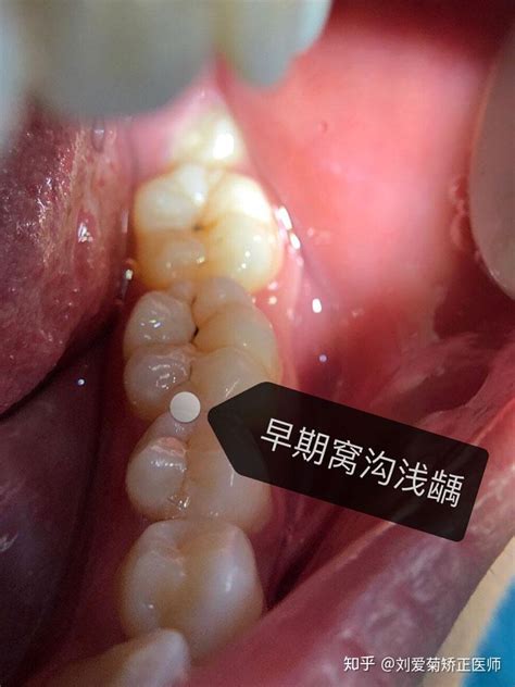 牙齿上的“黑线”、“黑点”是什么？ 知乎