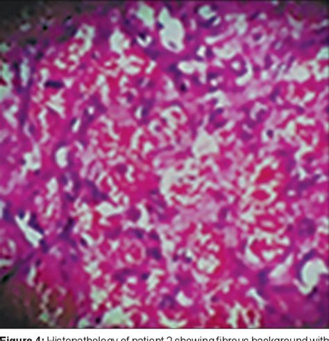 Figure 4 From Two Cases Of Giant Pyogenic Granuloma Of Scalp Semantic Scholar