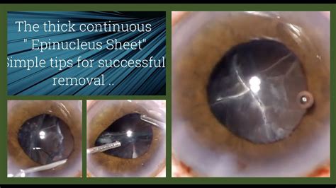 The Thick Troublesome Sheet Of Epinucleus Simple Tips For Its Easy Removal Youtube