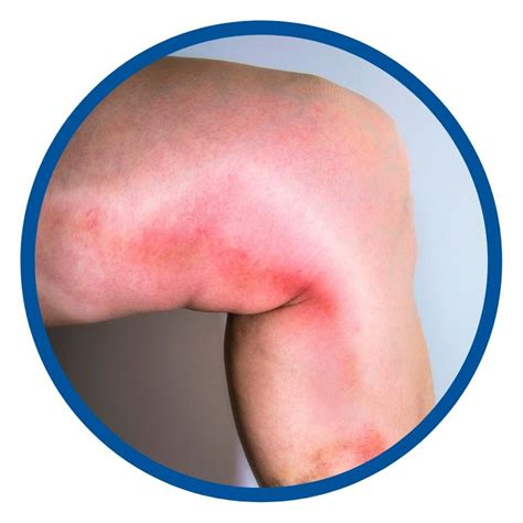 Vein Disease Superficial Thrombophlebitis Usa Vein Clinics