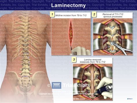 Laminectomy Trialquest Inc