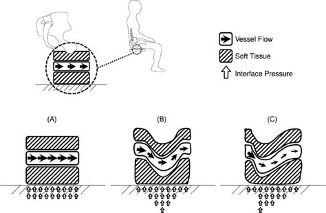 A Conceptual Schematic Of Three Ischial Tuberosity Pressure