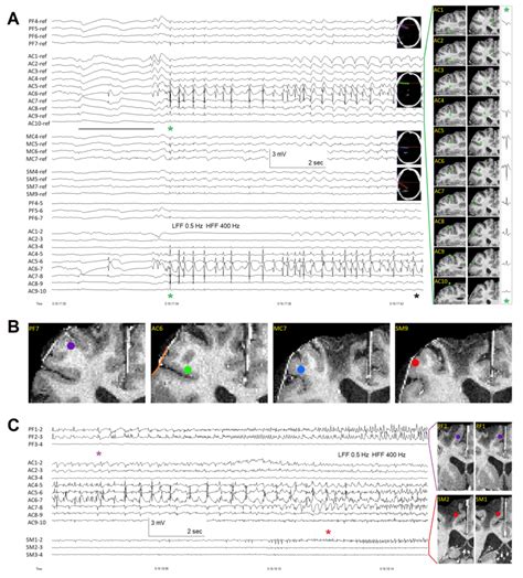 Stereotactic Eeg Seeg Recording In A Patient With Frontal Lobe Download Scientific Diagram