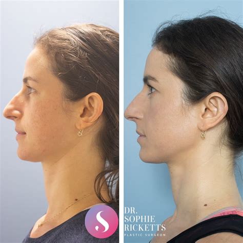 Ear Surgery Otoplasty Melbourne Dr Sophie Ricketts