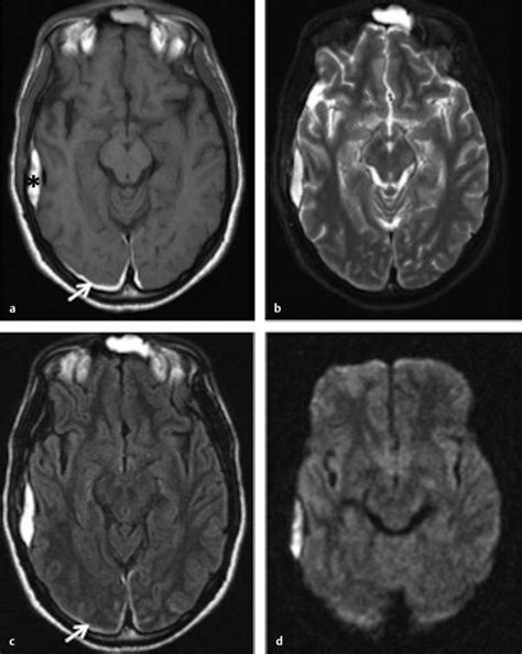 Diffusion Weighted Imaging In Hemorrhage Radiology Key