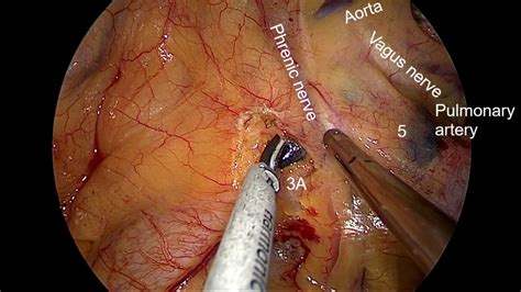 Anatomic Landmarks During Left Prevascular Lymph Node Dissection 3a Download Scientific Diagram