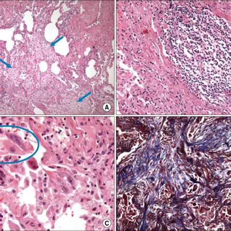A Chest X Ray Shows Patchy Nodular Ground Glass Opacity Infiltrations
