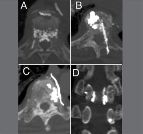 Postoperative Tomographic Control Showing Epidural Recess Download Scientific Diagram