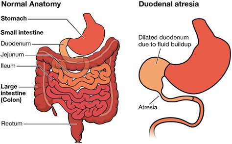 Large Bowel Obstruction