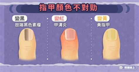 指甲有黑線凹陷變黃圖解8種指甲顏色變化恐是健康警訊 健康遠見