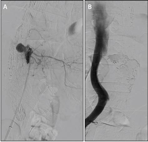 Coil Embolization Of Type Ii Endoleak Endovascular Today