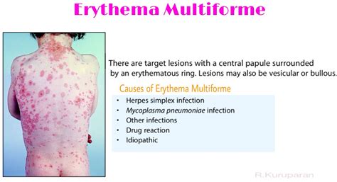 Erythema Multiforme Dermatology Nurse Dermatology Skin Assessment