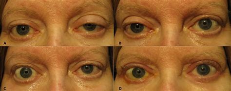 Efficacy Of Mullers Muscle And Conjunctiva Resection With Or Without Tarsectomy For The