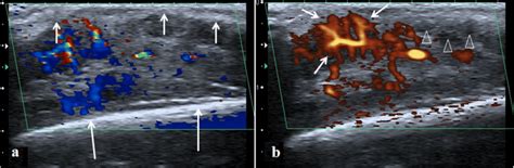Ultrasound Scan Of The Right Frontoparietal Region A The Color Doppler Download Scientific