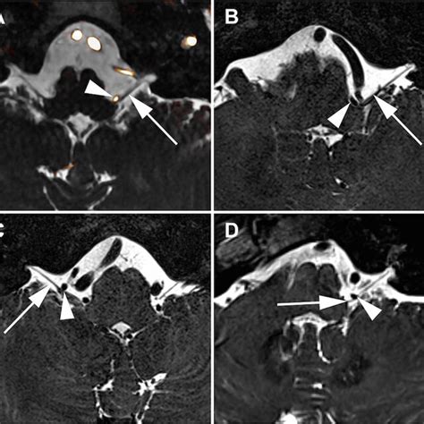 Axial High Resolution T2 Weighted Mri In Patients With Download