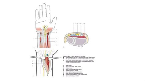 Distal End Of Radius Fracture And Dislocation Managementpptx Death Injury Or Military Distal End Of Radius Fracture And Dislocation Managementpptx Death Injury Or Military
