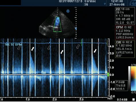 Continuous Wave Doppler Of Mitral Valve Tilting Disc Prosthesis White