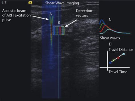 Shear Wave Elastography Radiology Key