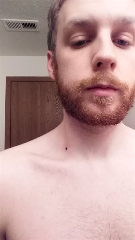 Pic Is This Virchows Node Medical