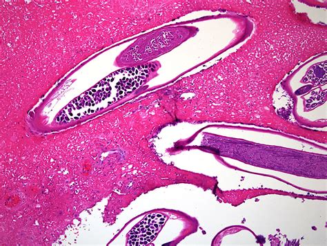 Onchocerca Volvulus Nodules