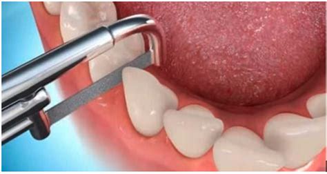 Home My Line Aligner