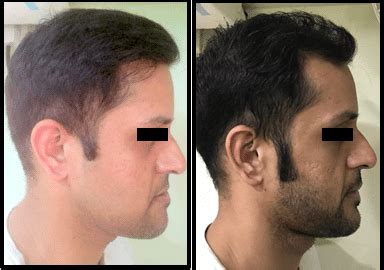 Pre And Post Comparison Download Scientific Diagram