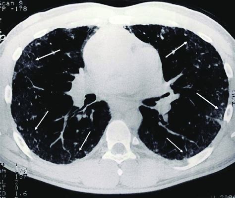 Ct Chest Showing Peripheral Interstitial Infiltrates With Patchy Areas