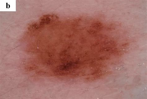 Dermoscopy Image A Before And B After Hair Removal Download Scientific Diagram