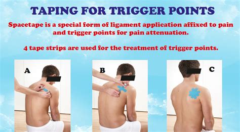 DrMitrPhysio Taping For Trigger Points
